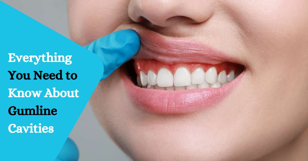 Everything You Need to Know About Gumline Cavities - Hand Family Dentistry